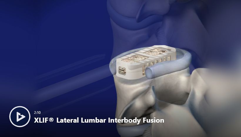 XLIF® Lateral Lumbar Interbody Fusion Video | Newport Orthopedic Institute