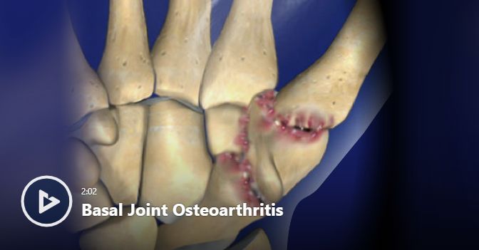 Basal Joint Osteoarthritis Video | Newport Orthopedic Institute
